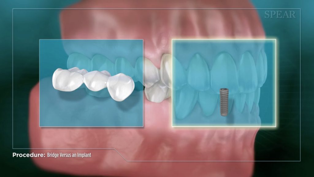 Bridge vs. Implant | Chapel Hill Periodontics & Implants