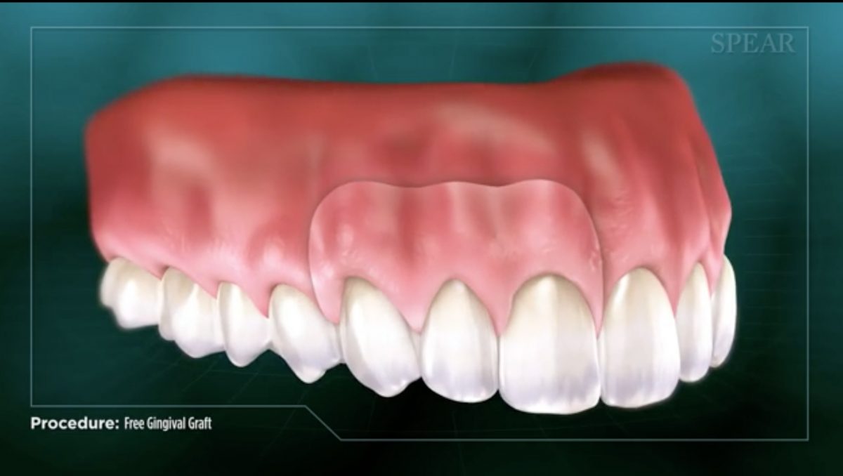 Portfolio Archive - Page 3 of 4 - Chapel Hill Periodontics & Implants